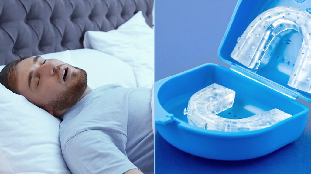 Mandibular Advancement Device for Sleep Apnoea – Advisor 2023