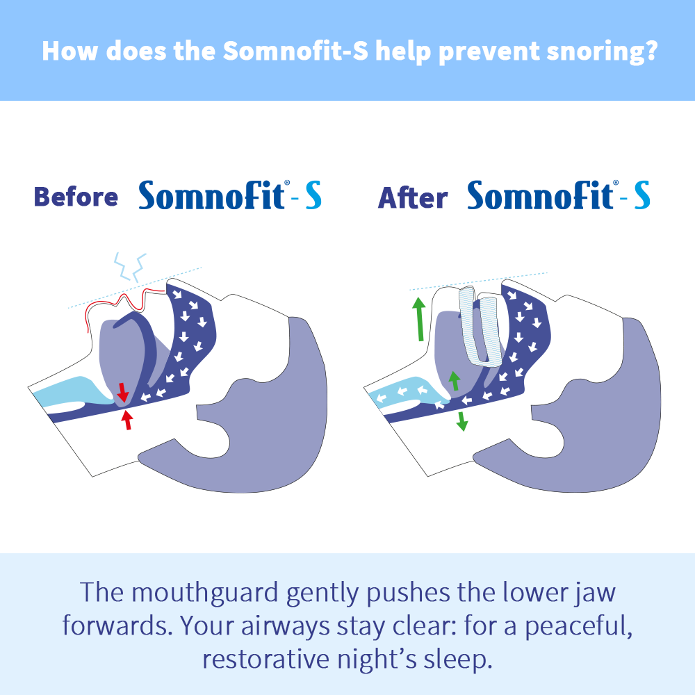 SomnoFit-S high-end Mandibular Advancement Device | SomniShop